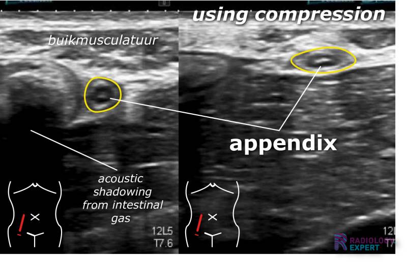 Abdominal ultrasound
